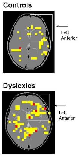 Understanding the Brain and Learning Disabilities: Lesson Plans